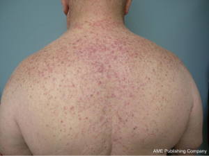 erbitux rash grading