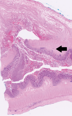 false diverticulum pathology