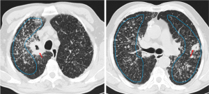 multiple lung cavities