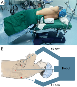 Robotic-assisted double-sleeve lobectomy - Qiu - Journal of Thoracic ...