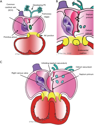 interatrial connection