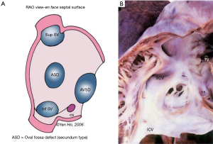 Anatomy of the atrial septum and interatrial communications - Naqvi ...