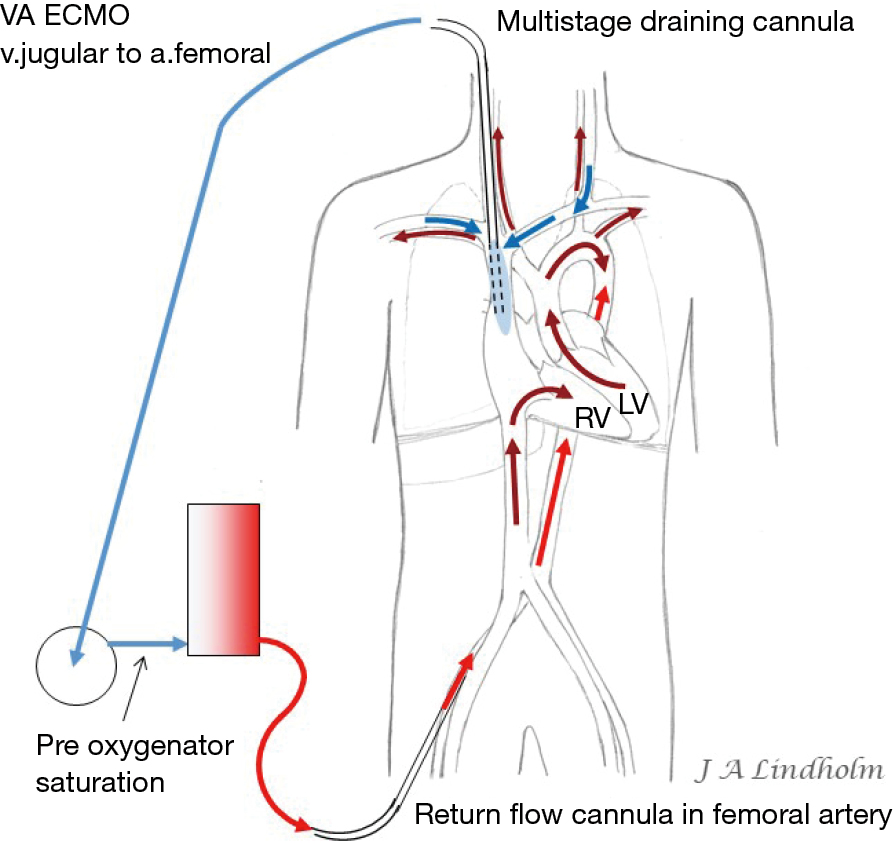 Lv Venting During Ecmo | Ahoy Comics