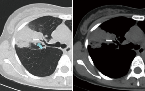 Surgical removal of an intrapulmonary aberrant needle: report of a case ...