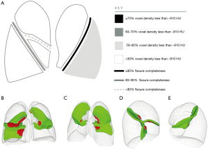 Emphysema and lung volume reduction: the role of radiology - Martini ...