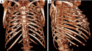 Surgical options to treat massive sternal defect after failed Robicsek ...