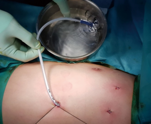 collapsed lung surgery