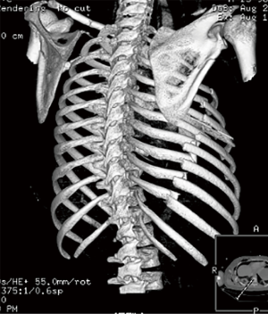 Chest wall stabilization and rib plating in 15-year-old male adolescent ...