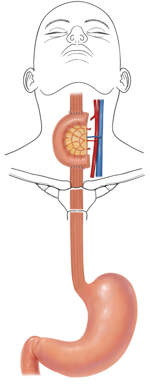Jejunal graft conduits after esophagectomy - Gaur - Journal of Thoracic ...