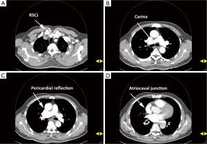 The carina is approximately 1-2 cm above the pericardial reflection ...