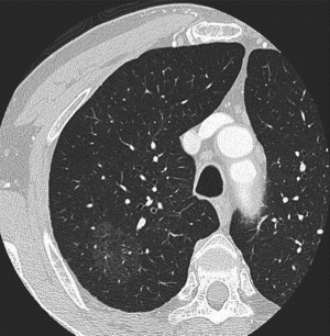 normal bronchoscopy report