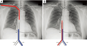 ecmo circuit chattering
