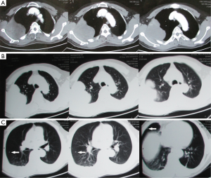Malignant giant cell tumor of the rib with lung metastasis in a man ...