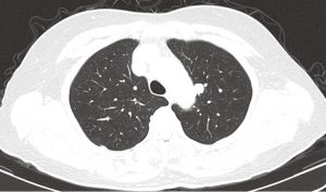 Video-assisted thoracoscopic left upper lobe apical trisegmentectomy ...