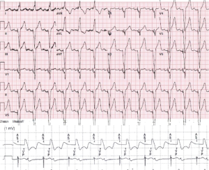 Inappropriate pacing due to T-wave oversensing - Fernandez - Journal of ...