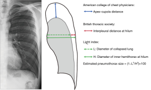 Interpleural distance predicts persistent air leak after initial ...