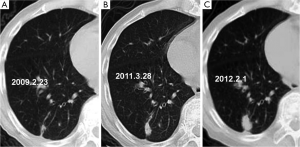 CT features of lung scar cancer - Gao - Journal of Thoracic Disease
