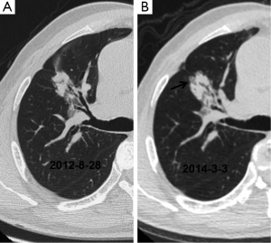 CT features of lung scar cancer - Gao - Journal of Thoracic Disease