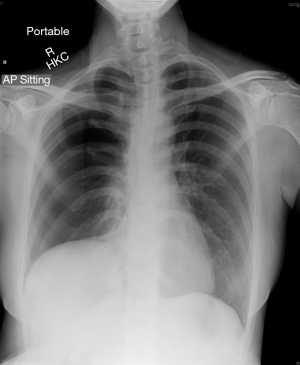 diaphragm elevated on right side