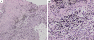 anthracosis lymph node