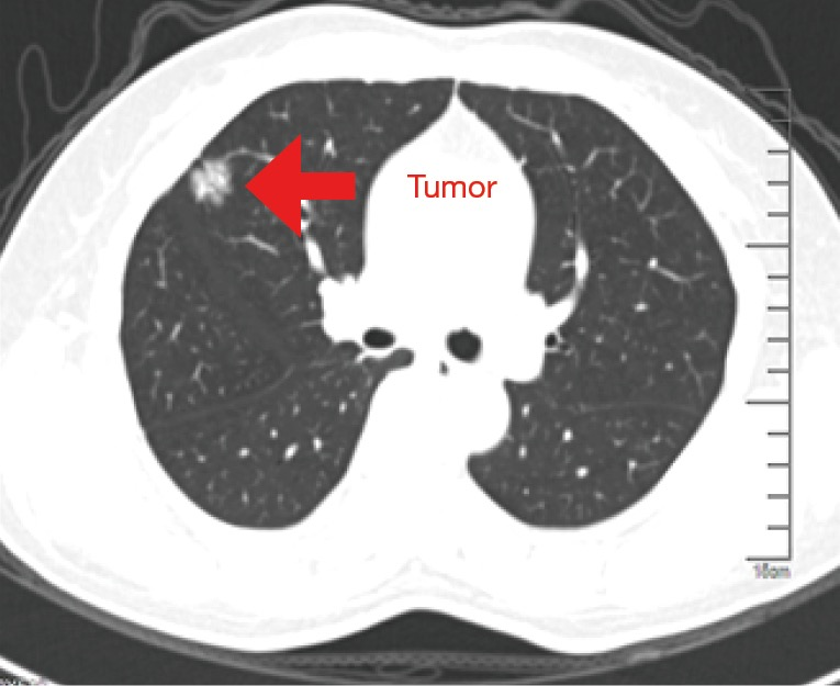 Radical resection of right upper lung cancer using uniportal video ...