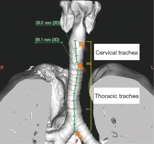 Significance of the evaluation of tracheal length using a three ...
