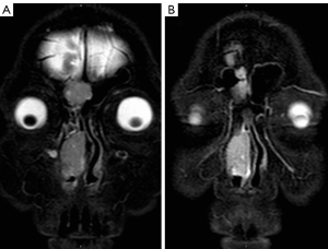 Case report: NUT carcinoma in an elderly woman with unique morphology ...