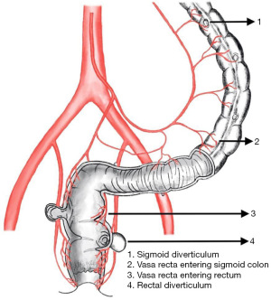 rectus diverticulum