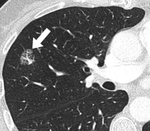 The natural course of incidentally detected, small, subsolid lung ...