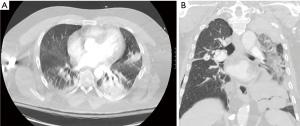 Contemporary management of pulmonary contusions: a narrative review ...