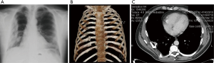 Surgical stabilization of flail chest after trauma: when, why and how ...