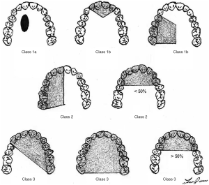 Reconstruction of midfacial defects - Lago-Beack - Frontiers of Oral ...