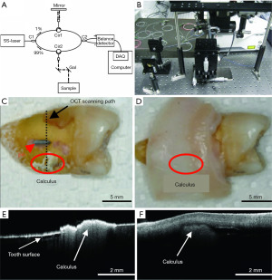 subgingival calculus causes