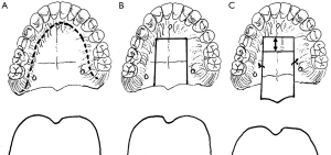 Treatment option for chronic gag reflex with palate push-back osteotomy ...