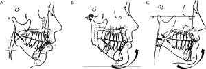 Treatment option for chronic gag reflex with palate push-back osteotomy ...