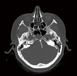 Surgically managed symptomatic ecchordosis physaliphora: a systematic ...