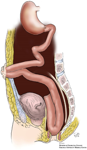 kock pouch procedure