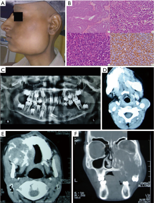 ewing sarcoma family of tumors