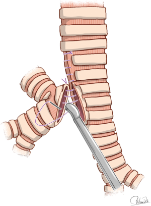 Video-assisted thoracoscopic surgery (VATS) for central airway tumors ...