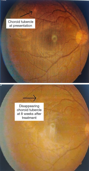 choroidal tubercles