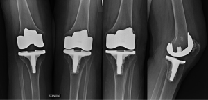 pseudogout knee replacement